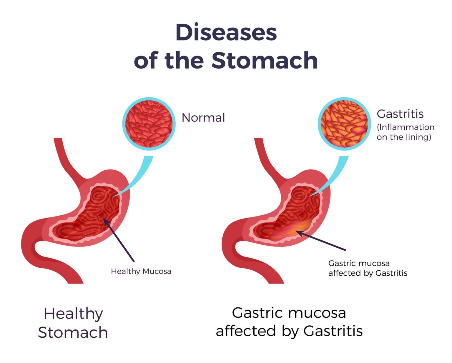Stomach Woes: Gastritis and its Hidden Symtoms